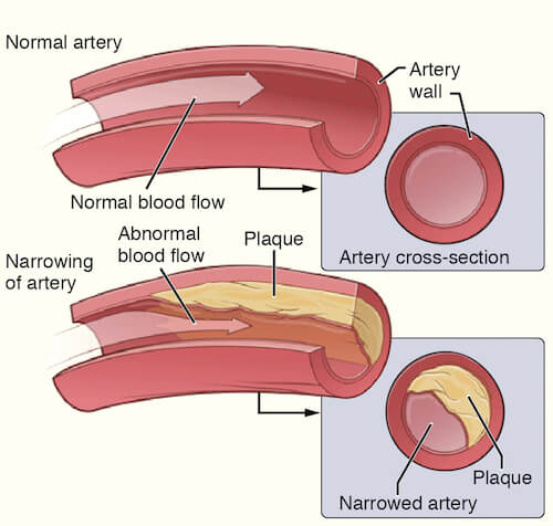 Peripheral Arterial Disease | Manhattan Cardiology | Manhattan, NY