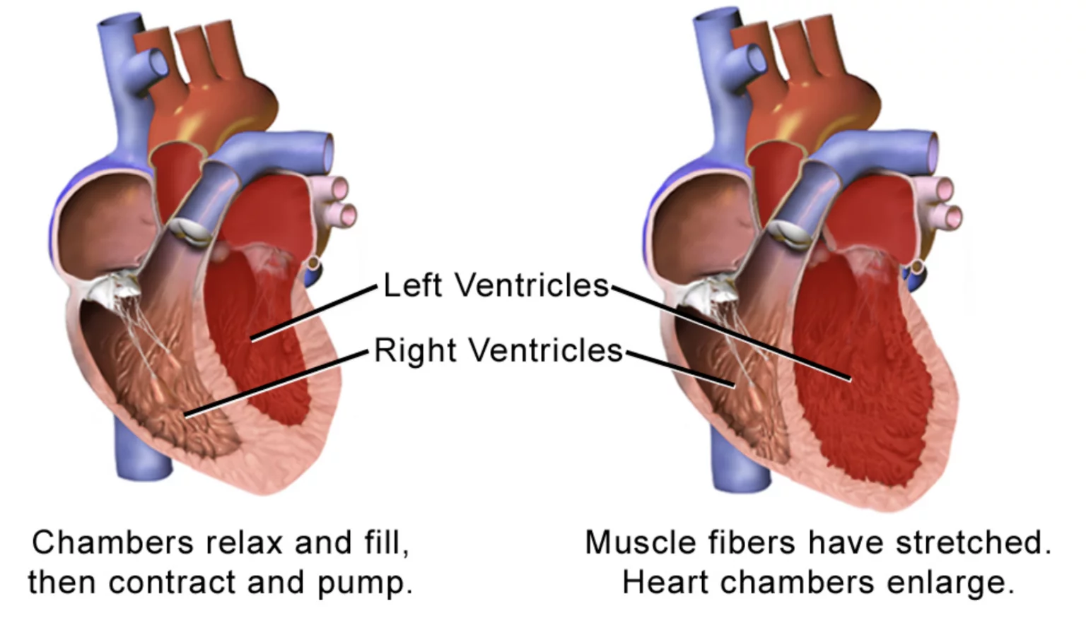 Broken Heart Syndrome | Manhattan Cardiology | Manhattan, NY