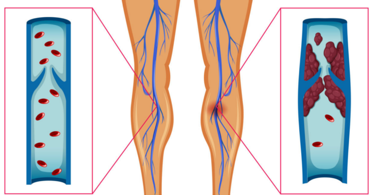 Blood Clotting | Manhattan Cardiology | Manhattan, NY