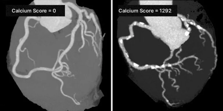 Coronary Calcium Scan | Manhattan Cardiology | Manhattan, NY
