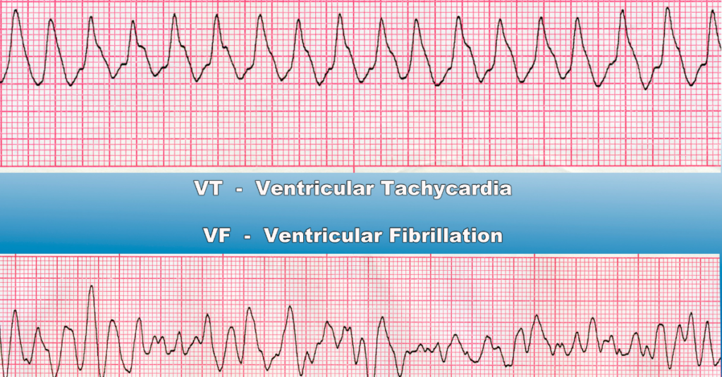 Tachycardia Manhattan Cardiology
