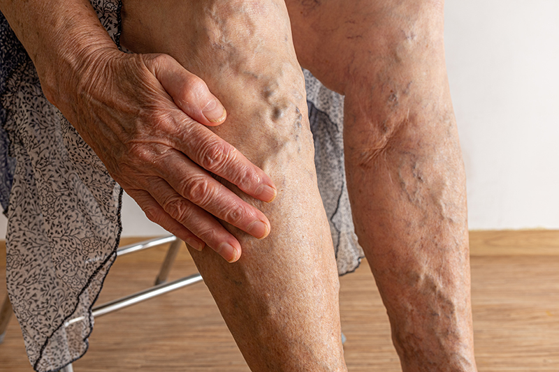 Deep Vein Thrombosis | Manhattan Cardiology | Manhattan, NY